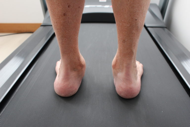 ¡Me he lesionado el ligamento de Spring! - Biomecánica Martínez