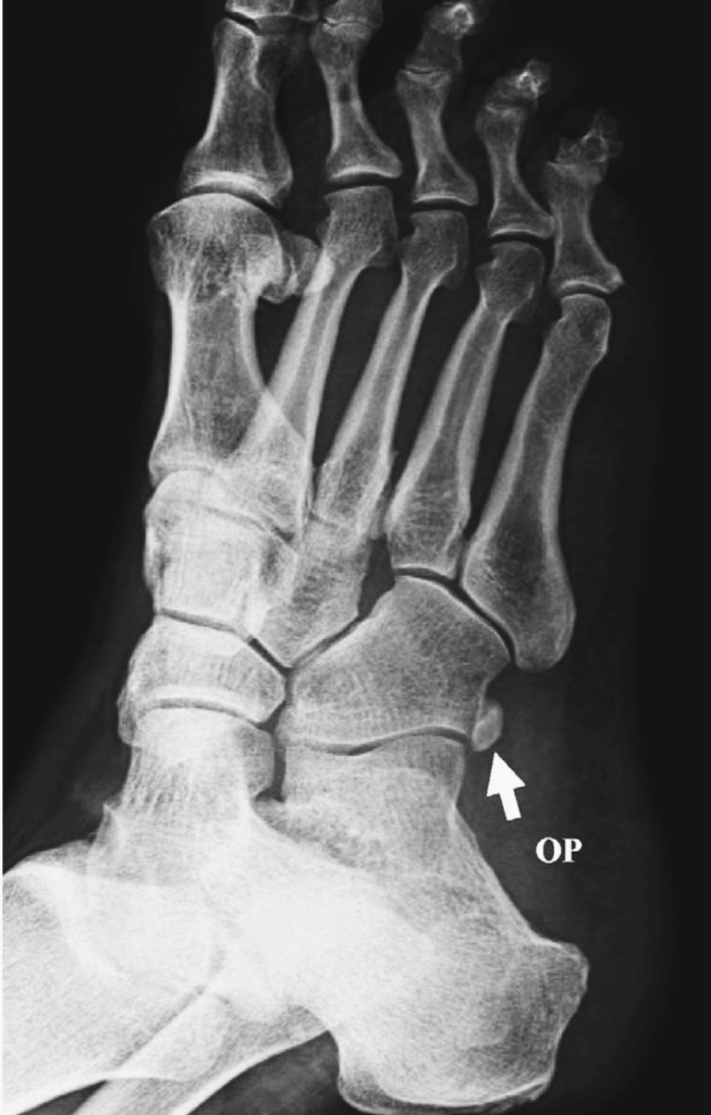 ¡Lesiones en los tendones peroneos! - Biomecánica Martínez