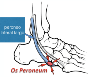¡Lesiones en los tendones peroneos! - Biomecánica Martínez