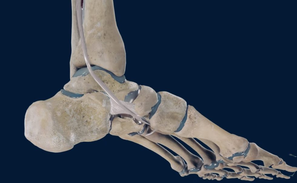 ¡Tendinosis del tibial posterior con PRP! - Biomecánica Martínez